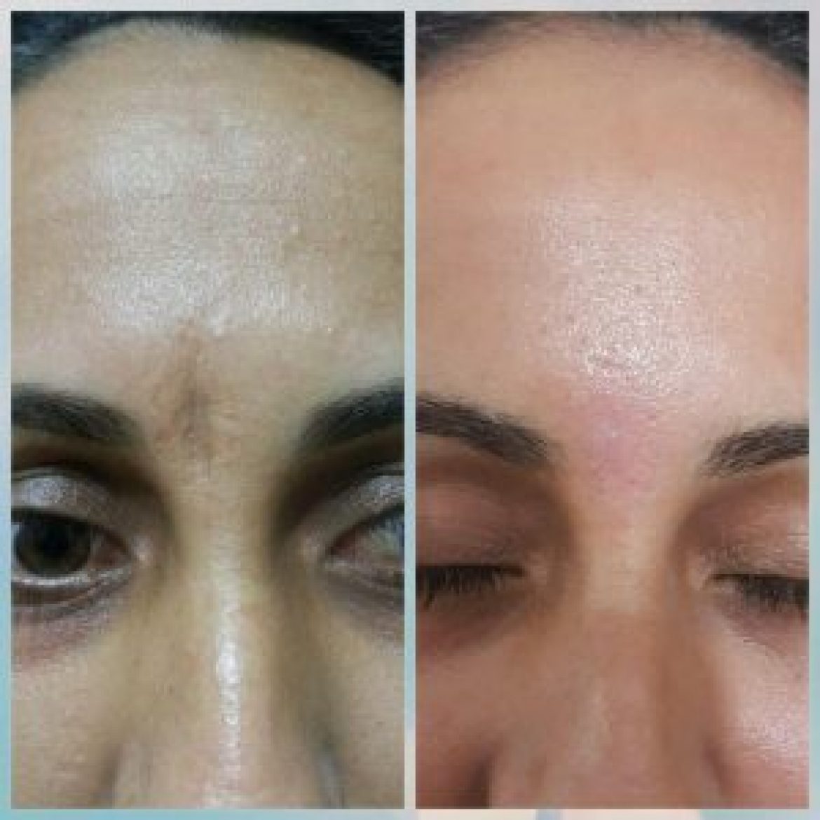 کلینیک پوست مو و زیبایی دکتر امیر فیلی تصحیح اسکار اتروفیک پیشانی توسط لیزر