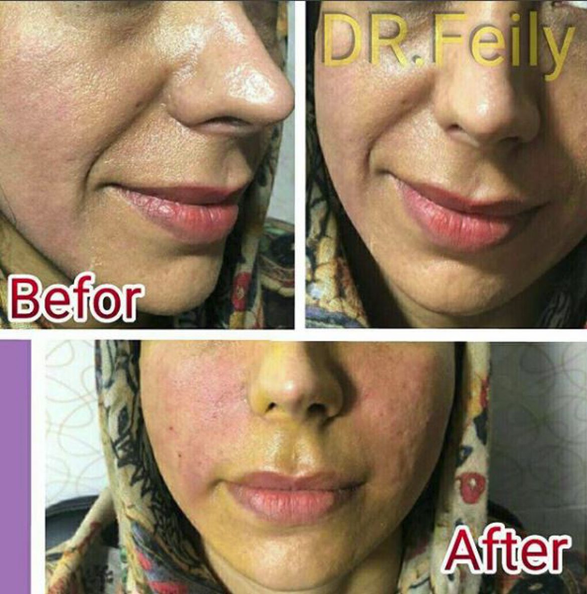 کلینیک پوست مو و زیبایی دکتر امیر فیلی961561 تزریق فیلر خط خنده